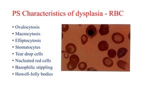 Myelodysplastic Syndrome.pptx