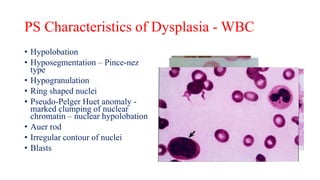 Myelodysplastic Syndrome.pptx