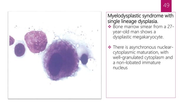 Myelodysplastic syndrome according to WHO 2016 | PPTX | Blood Disorders ...