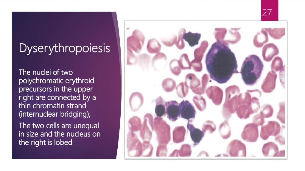 Myelodysplastic syndrome according to WHO 2016