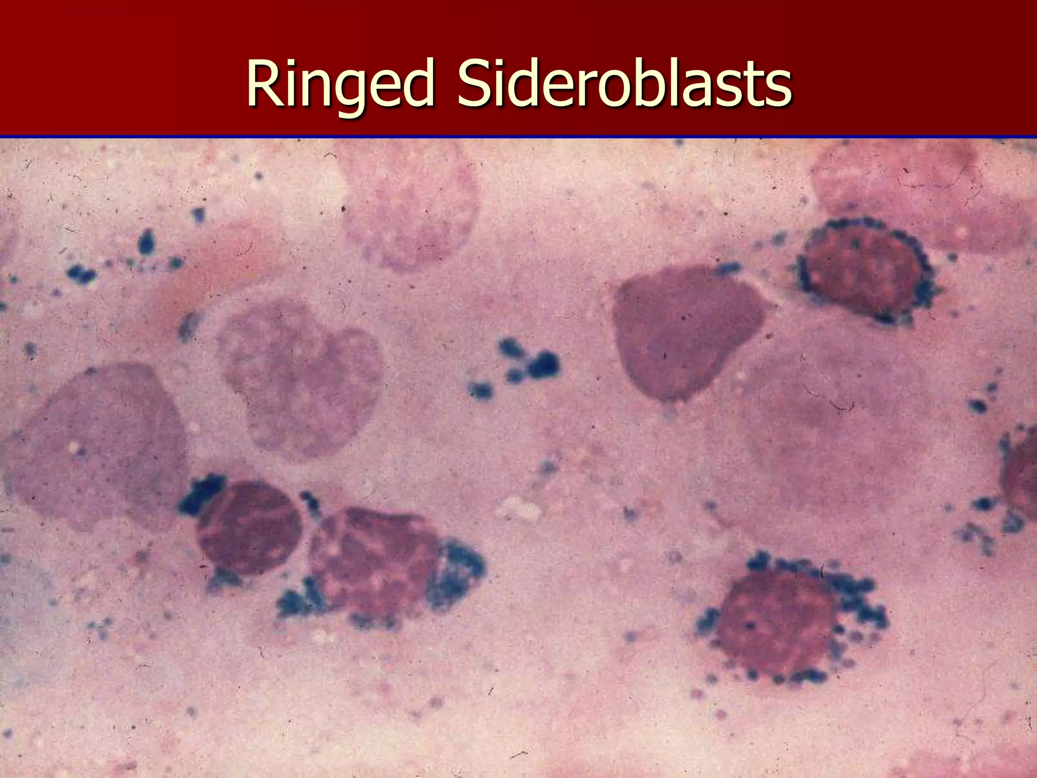myelodysplastic_syndromes.ppt