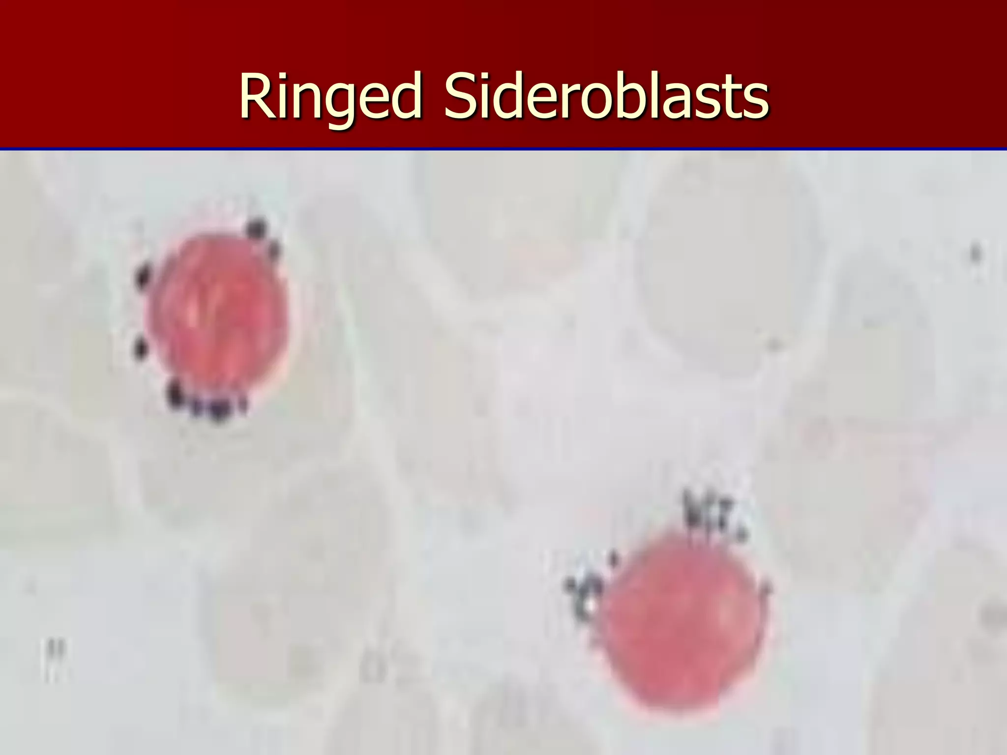 myelodysplastic_syndromes.ppt