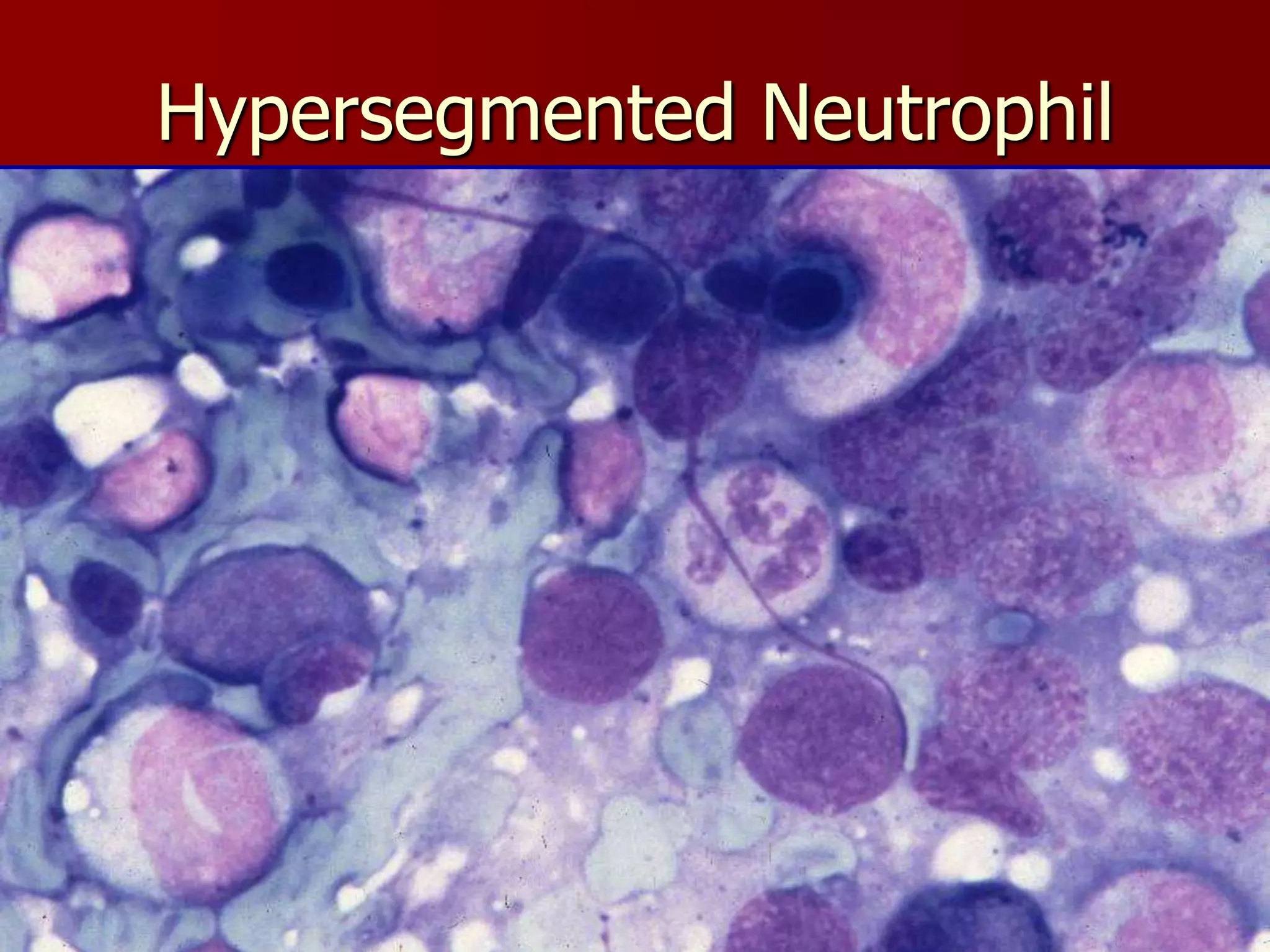myelodysplastic_syndromes.ppt