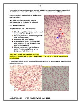 Myelofibrosis | PDF