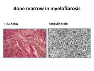 Myelofibrosis Bone Marrow