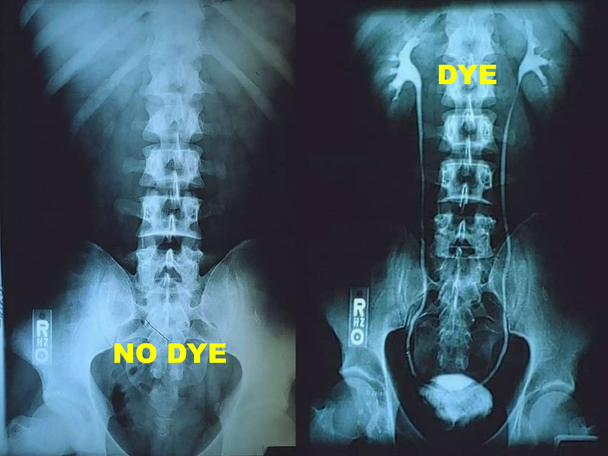 Myelography | PPTX