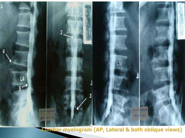 Myelography | PPTX | Brain and Nervous System Disorders | Diseases and ...