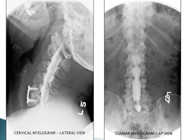 Myelography | PPTX | Brain and Nervous System Disorders | Diseases and ...
