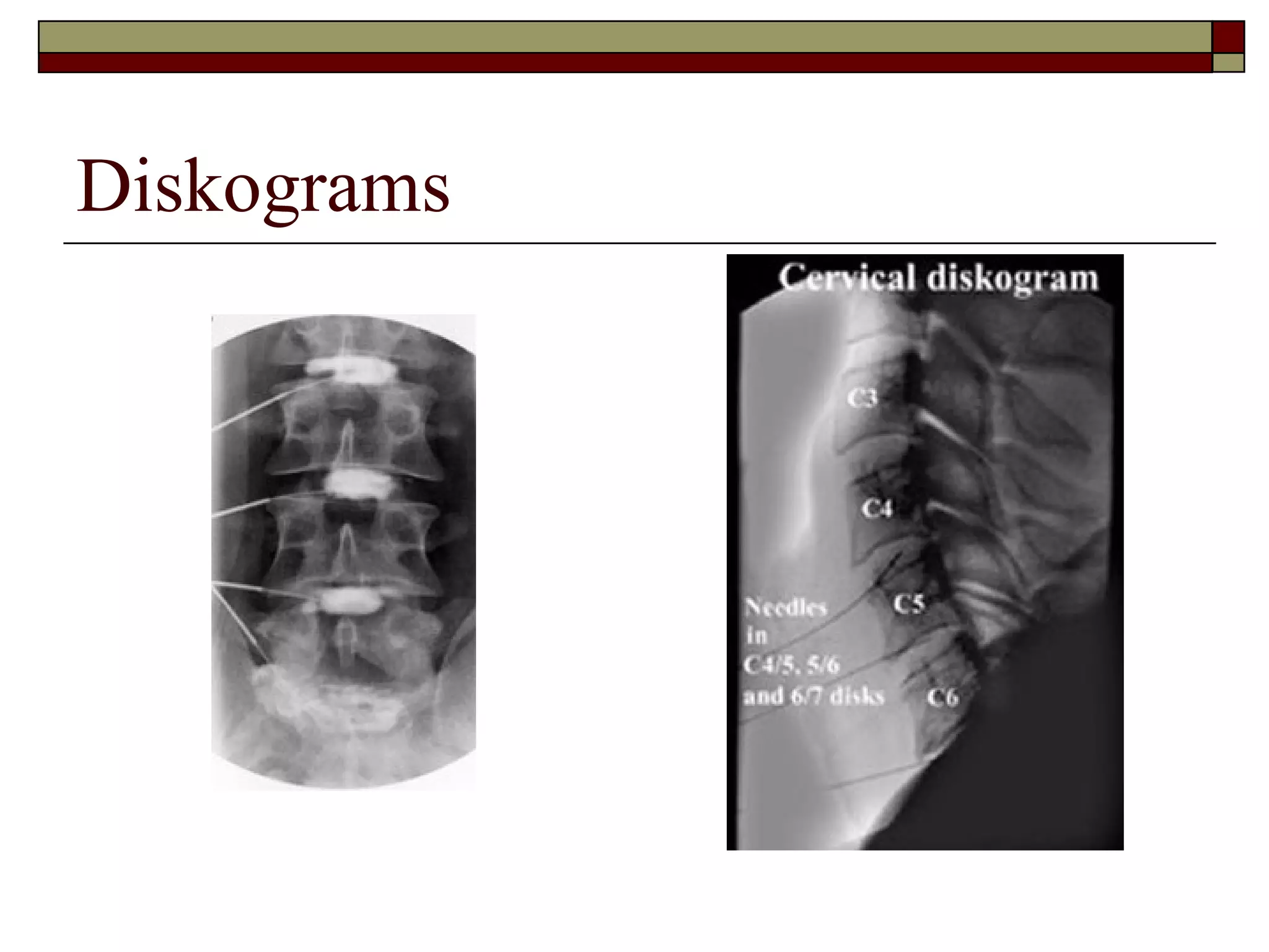 Myelography | PPT
