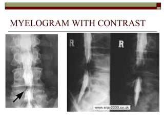 Myelography | PPT | Physical Therapy | Wellness