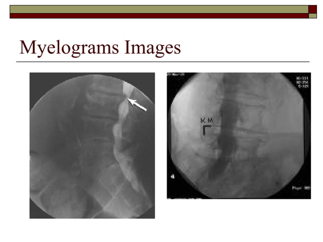 Myelography | PPT | Physical Therapy | Wellness