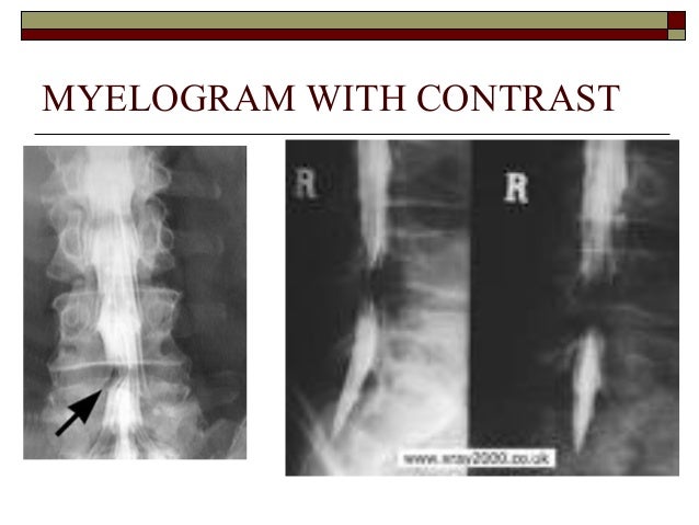 Myelography