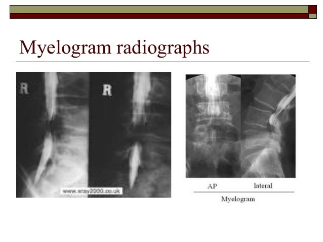 Myelography