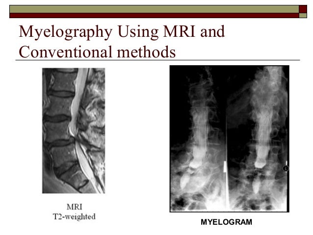 Myelography