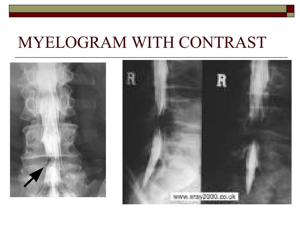 Myelography