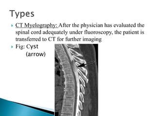 Myelography PPT bmit 4th Semester .pptx