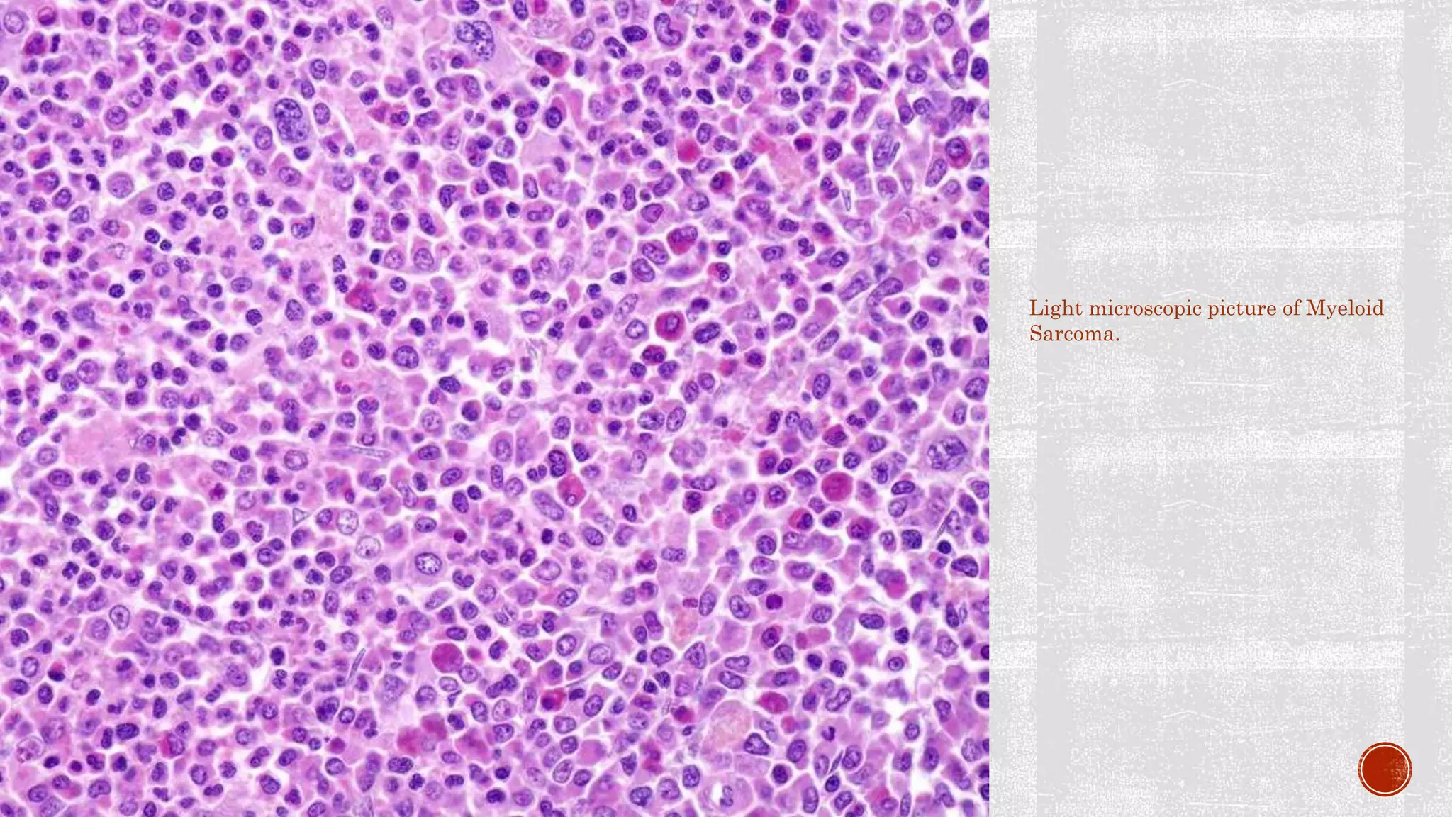 Myeloid sarcoma.pptx