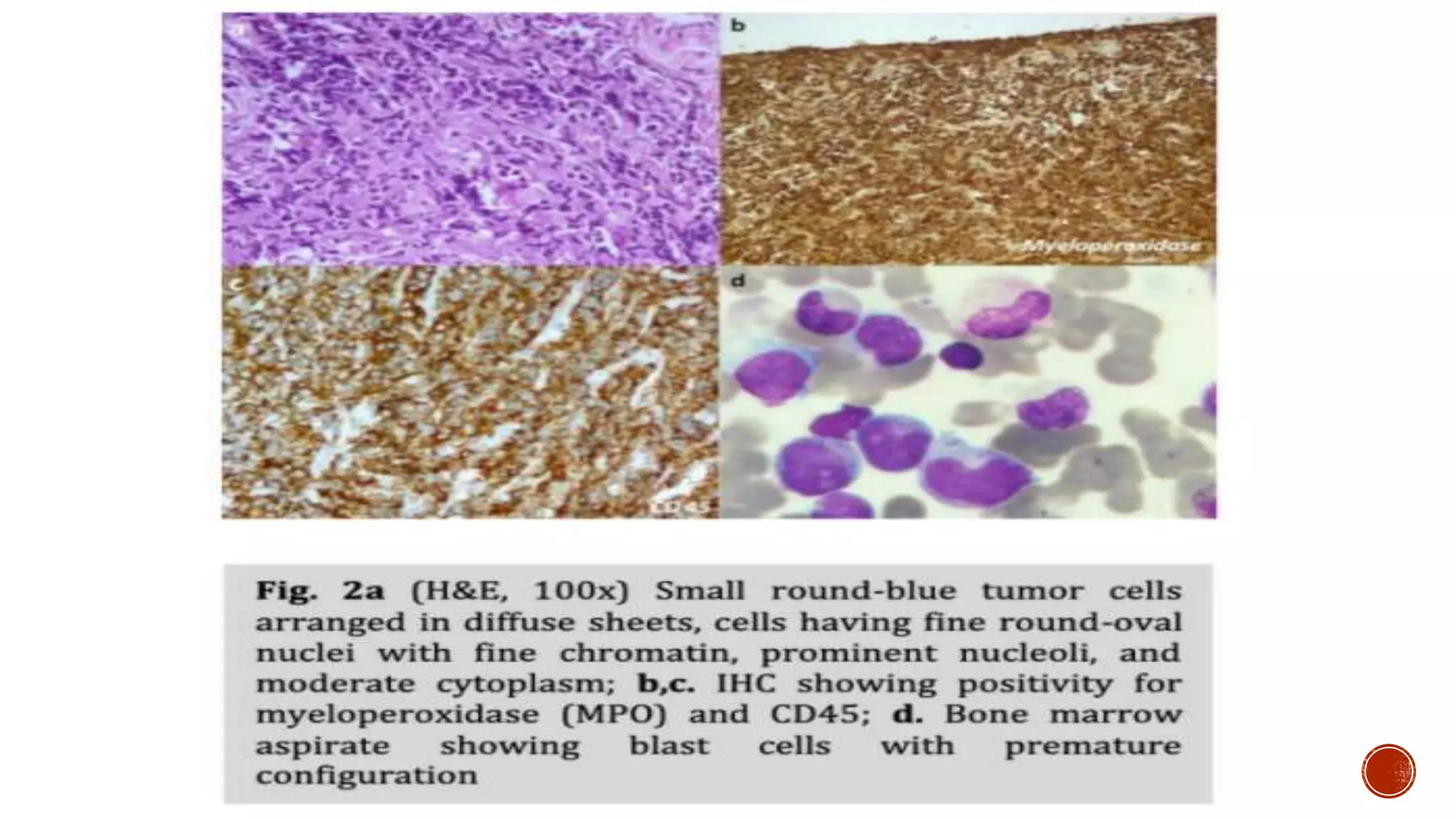 Myeloid sarcoma.pptx