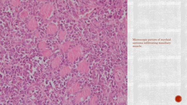 Myeloid sarcoma.pptx