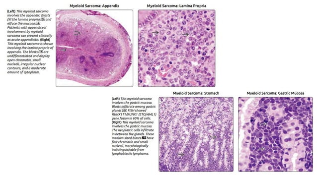 Myeloid sarcoma.pptx
