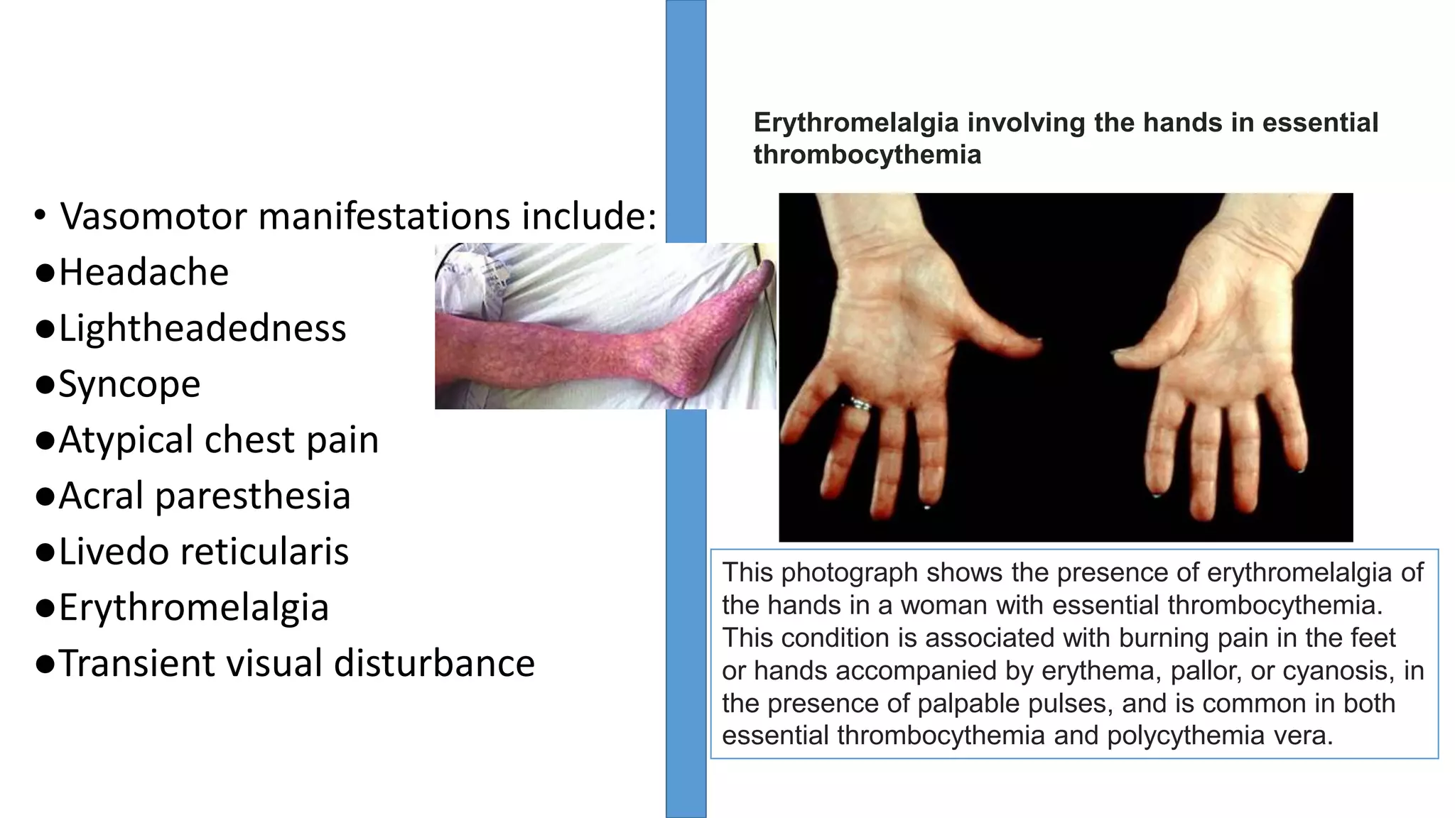 Myeloproliferative disorders | PPTX