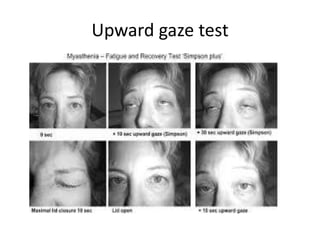 Myesthenia gravis | PPTX