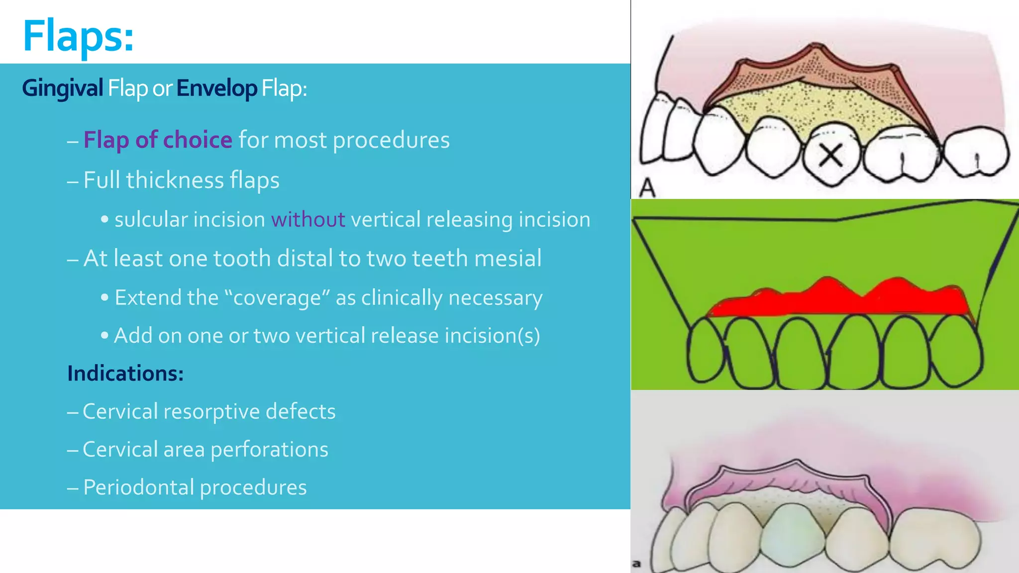 Oral Surgery Flaps Desgning | PDF
