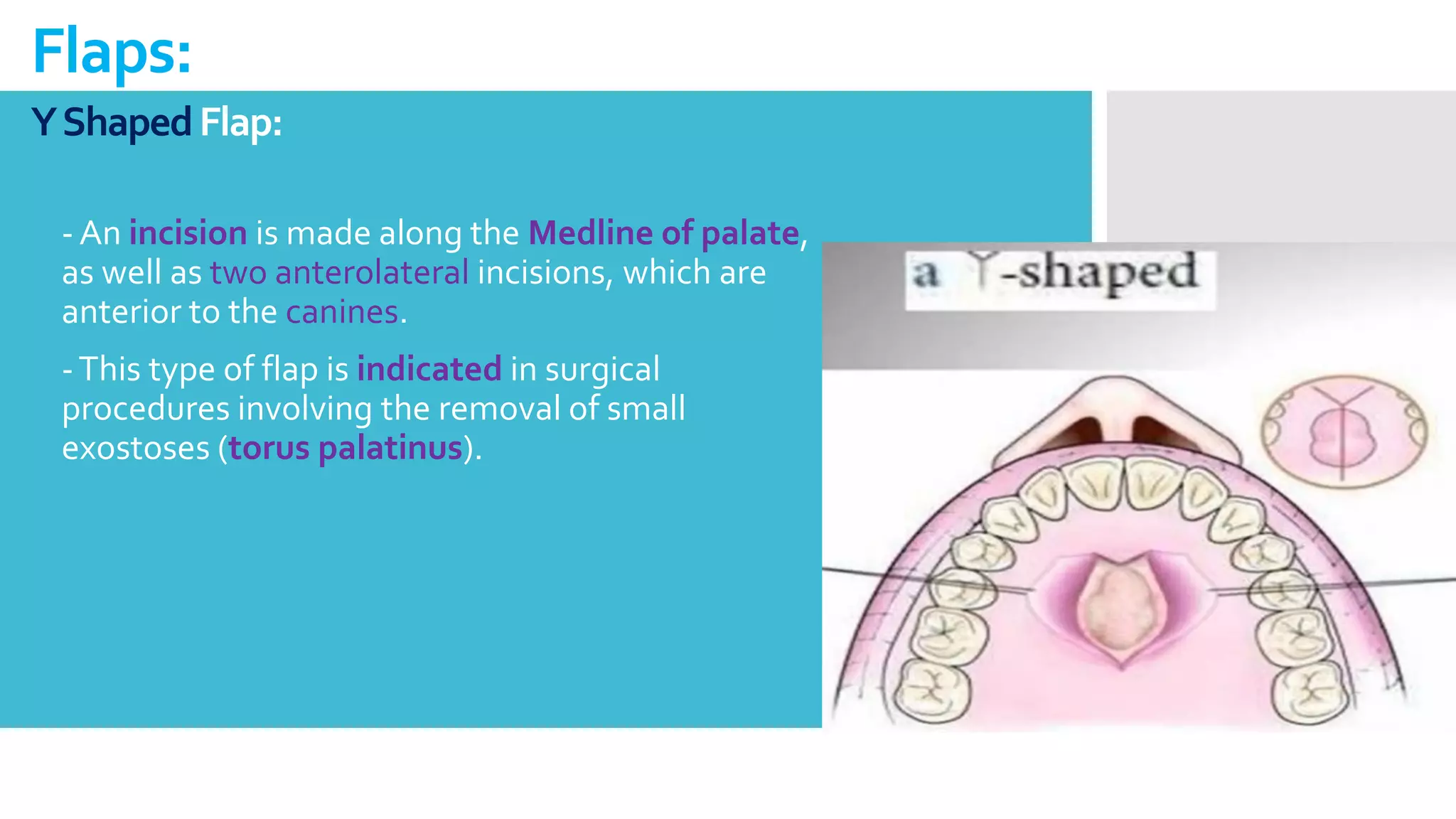 Oral Surgery Flaps Desgning | PDF