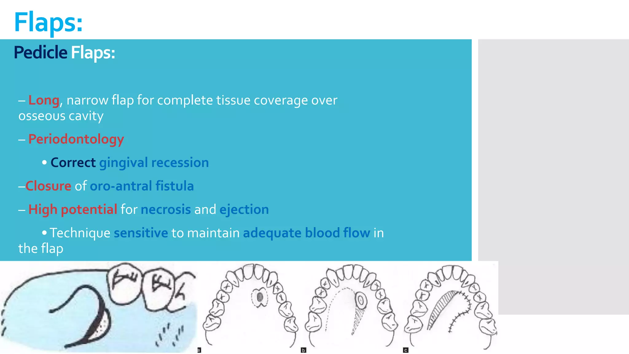 Oral Surgery Flaps Desgning | PDF