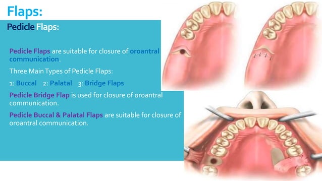 Oral Surgery Flaps Desgning | PDF