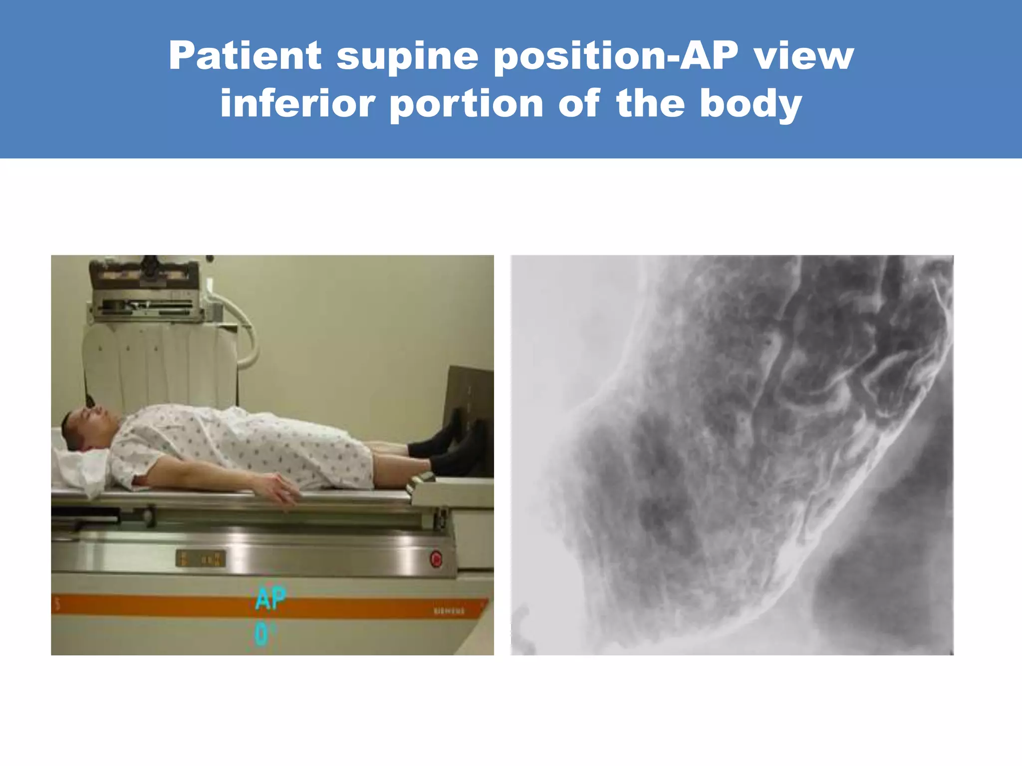 Learn Barium Meal & Follow Through | PPTX