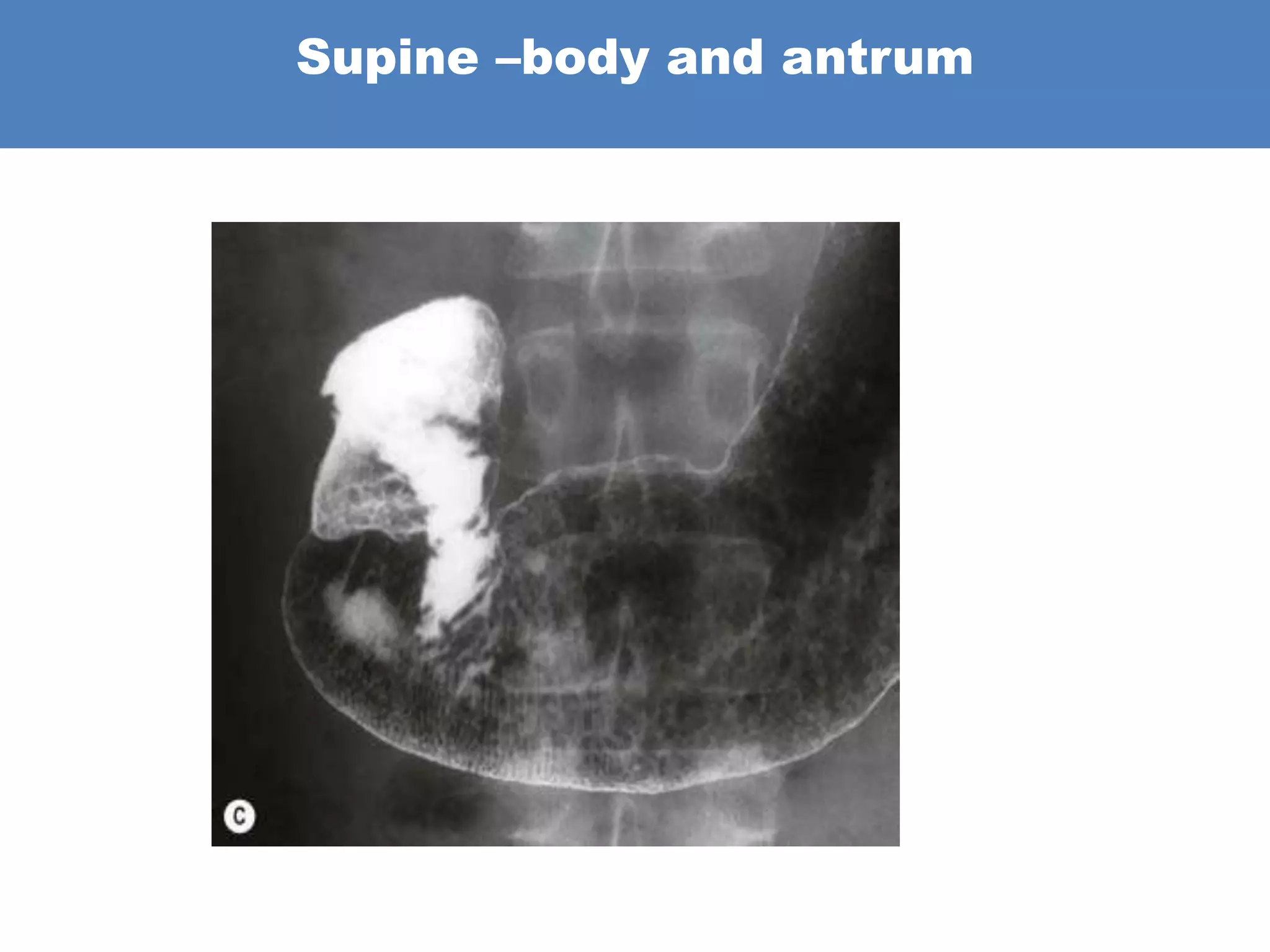 Learn Barium Meal & Follow Through | PPTX