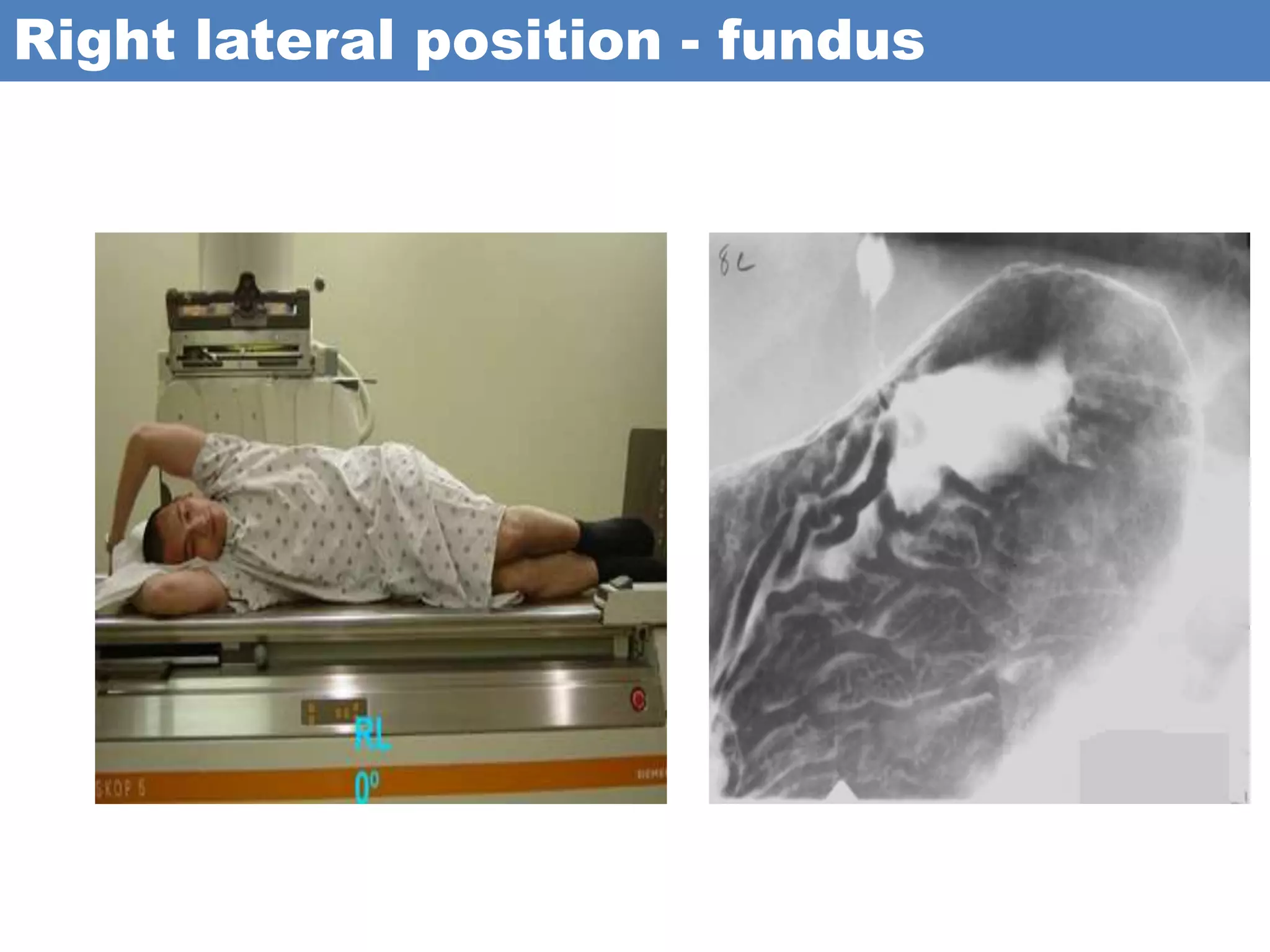 Learn Barium Meal & Follow Through | PPTX