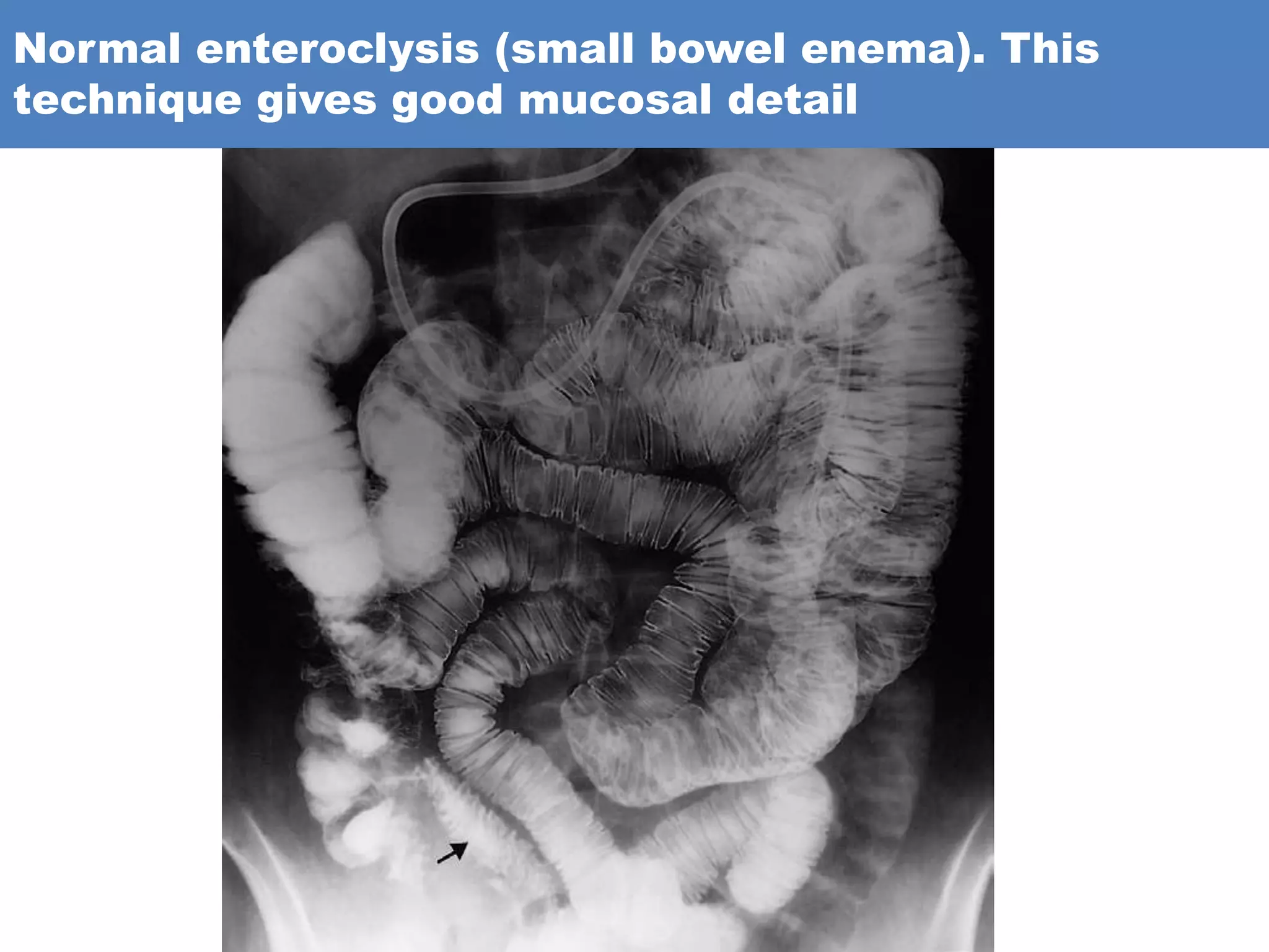 Learn Barium Meal & Follow Through | PPTX