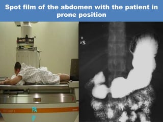 Learn Barium Meal & Follow Through | PPT