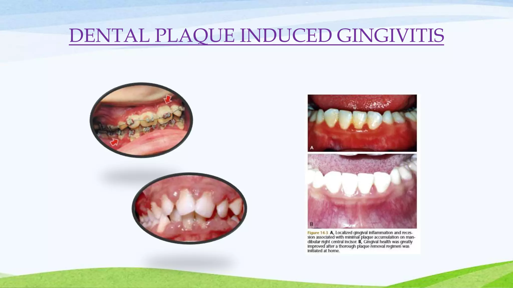 Gingival and periodontal diseases in children | PPTX