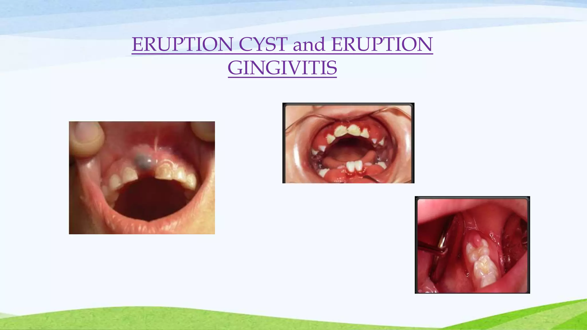 Gingival and periodontal diseases in children | PPTX