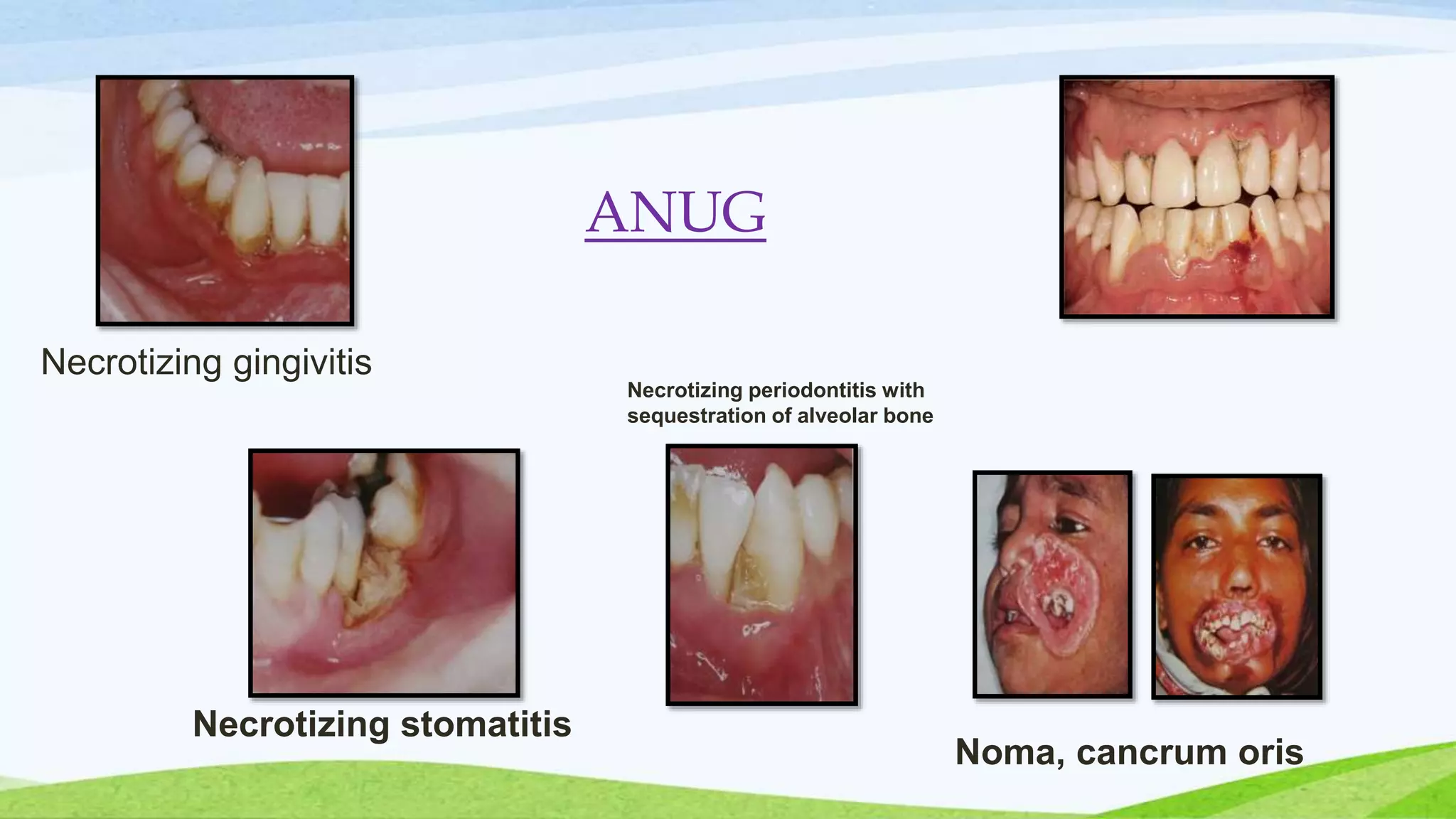 Gingival and periodontal diseases in children | PPTX
