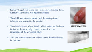 Gingival and periodontal diseases in children | PPTX