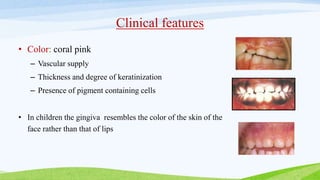 Gingival and periodontal diseases in children | PPTX