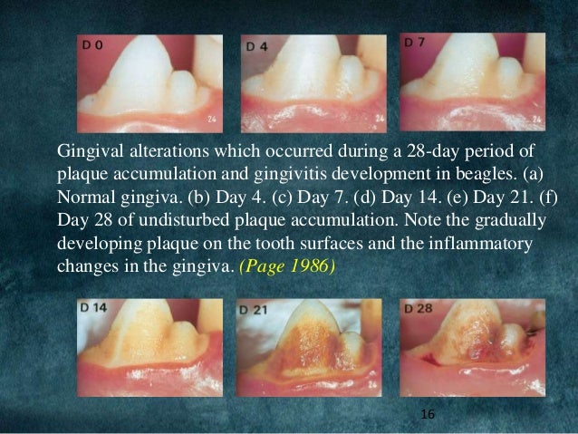 CLINICAL FEATURES OF GINGIVITIS AND ITS CORRELATION WITH MICROSCOPIC