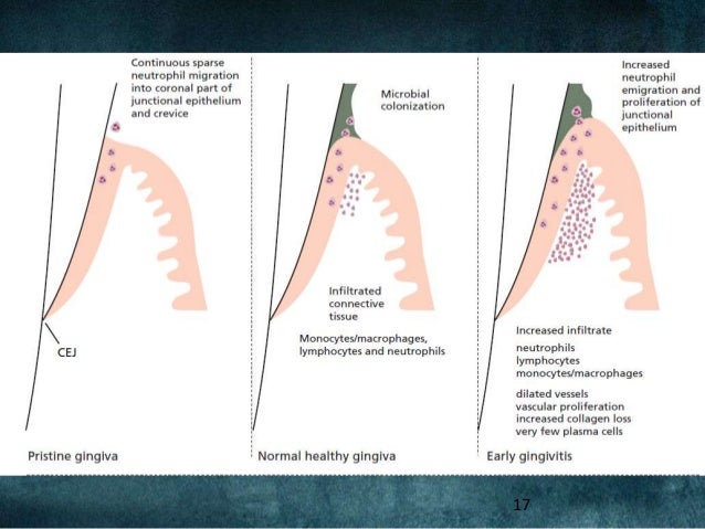 CLINICAL FEATURES OF GINGIVITIS AND ITS CORRELATION WITH MICROSCOPIC