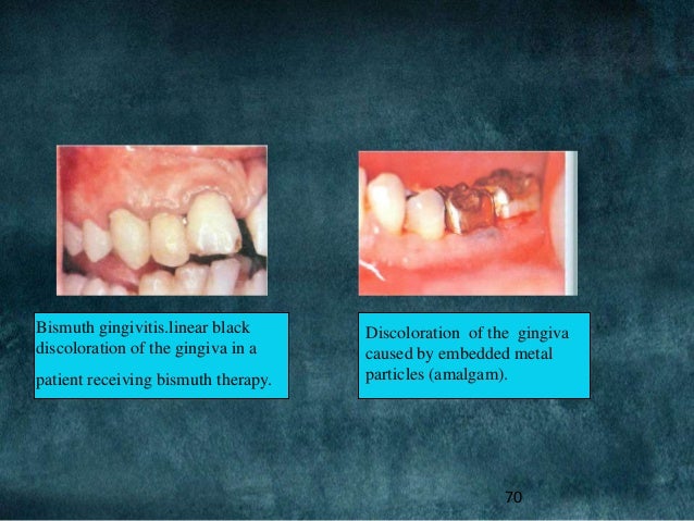 CLINICAL FEATURES OF GINGIVITIS AND ITS CORRELATION WITH MICROSCOPIC