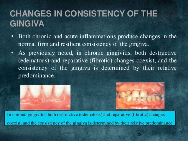 CLINICAL FEATURES OF GINGIVITIS AND ITS CORRELATION WITH MICROSCOPIC