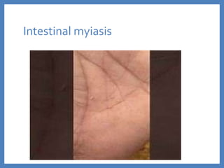 MYIASIS AND MAGGOT THERAPY.ppt