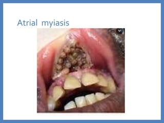 MYIASIS AND MAGGOT THERAPY.ppt