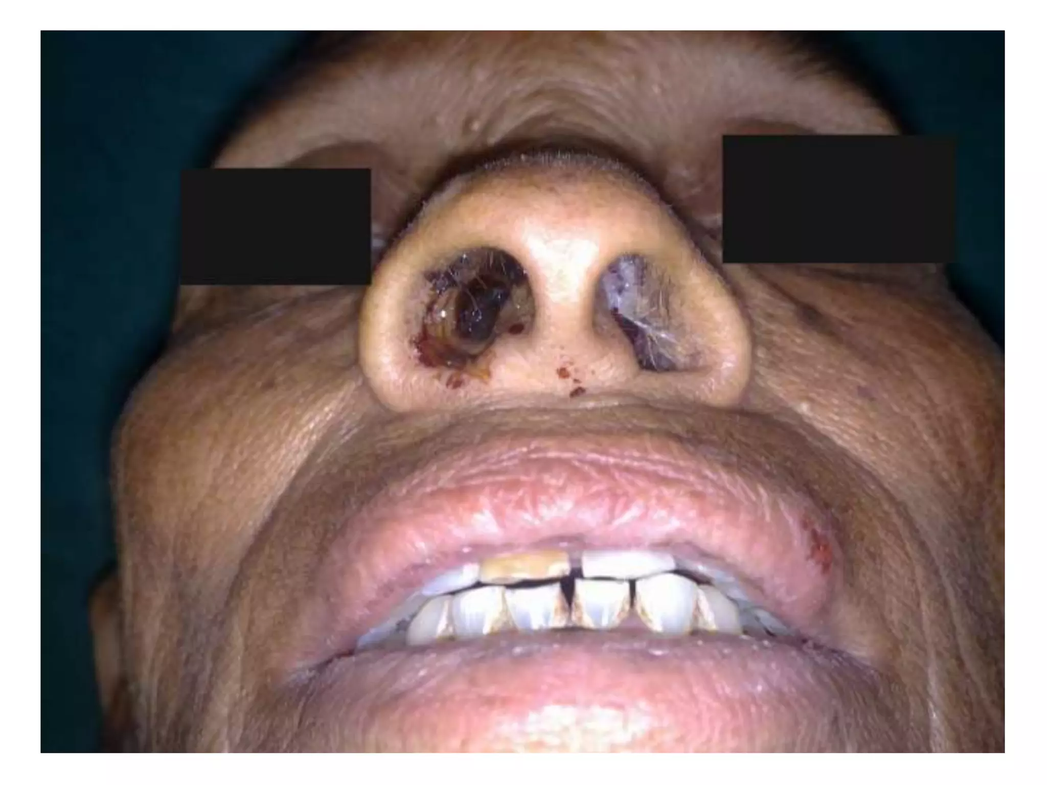 Myiasis by aseem | PPTX