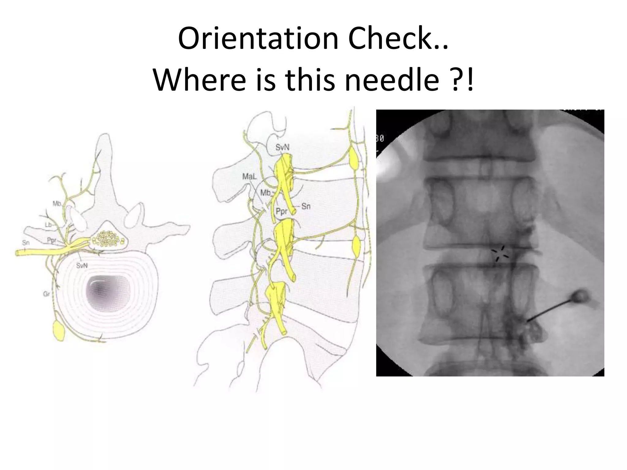 Radiofrequency in Spine Practice : introductory concerns | PPTX