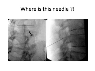 Radiofrequency in Spine Practice : introductory concerns | PPTX