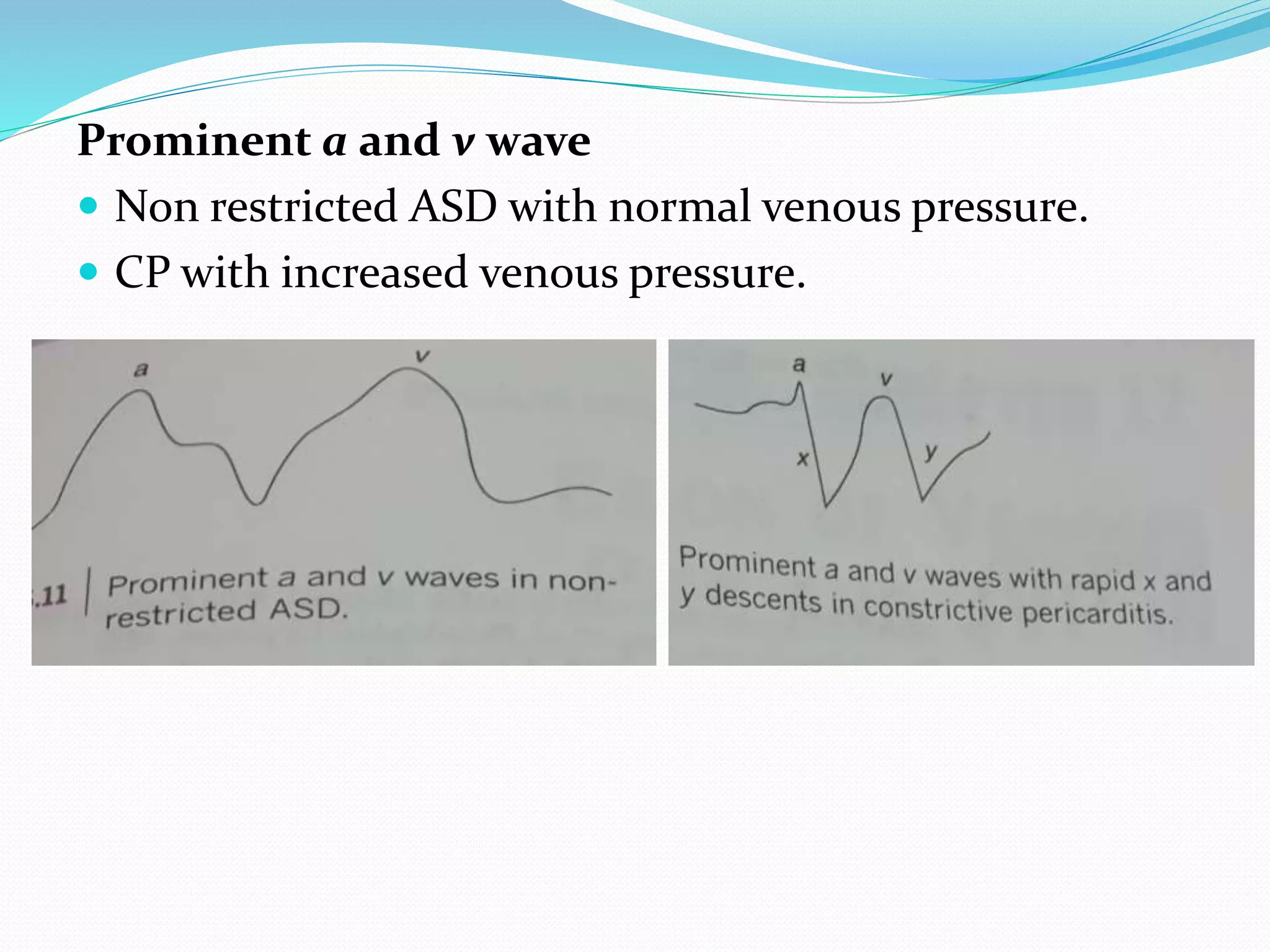 Jugular venous pressure | PPTX